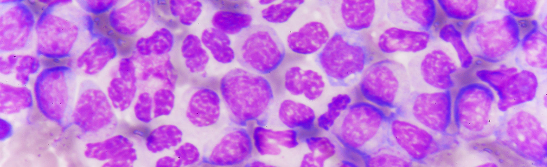 Precision Diagnosis in Pediatric Leukemia Gains Ground; Widespread ...