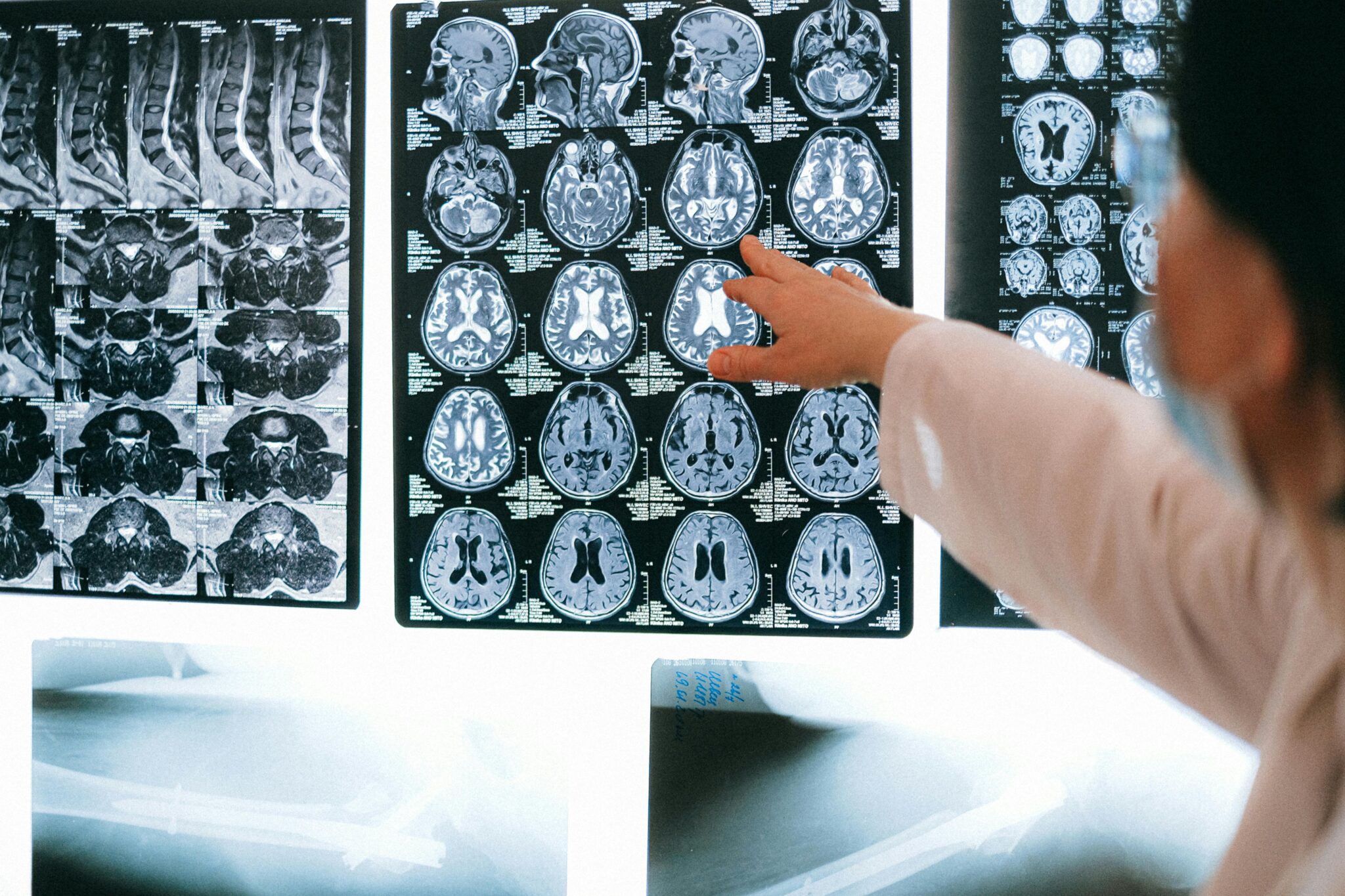 The Most Common Types of Brain Cancers in Children - Pediatric Cancer ...