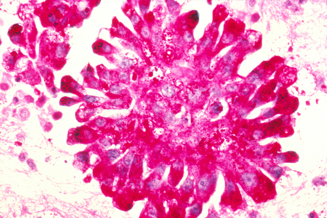 What You Should Know About Pediatric Sarcomas - Pediatric Cancer ...